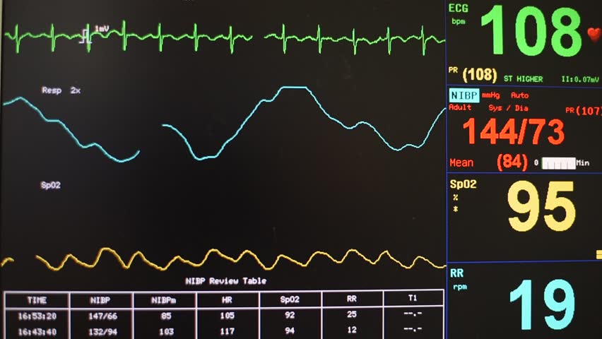 EKG Monitor In ICU Unit Show The Waves Of Blood Pressure, Blood Oxygen ...