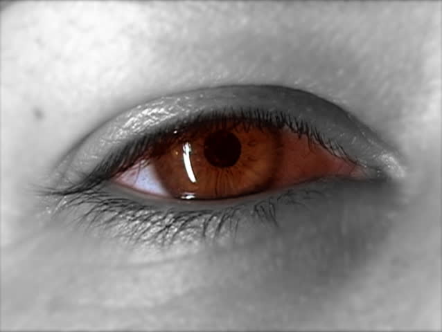 Female Red Eye Looks Up, Left Right And Down. Redness Resembles Pink ...