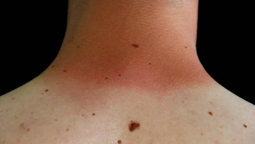 Skin Cancer Stock Footage Video | Shutterstock