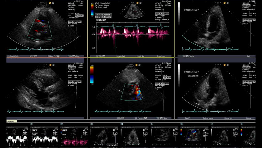 Echocardiogram Stock Video Footage - 4K and HD Video Clips | Shutterstock