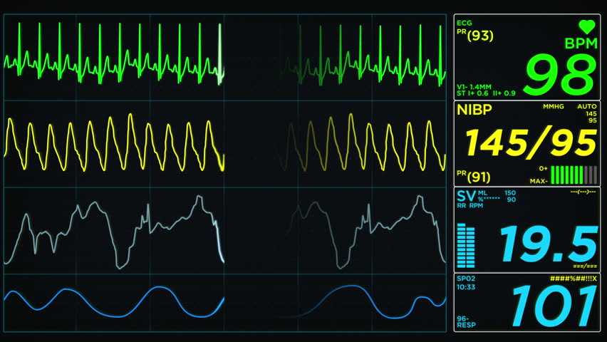 Medical Monitor Screen On Normal Heart Rate Loop Stock Footage Video ...
